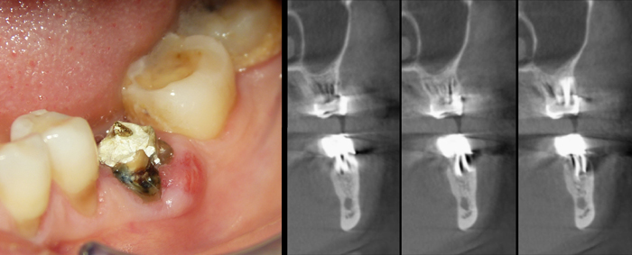 A New Tooth Processing Apparatus Allowing to Obtain Dentin Grafts for ...