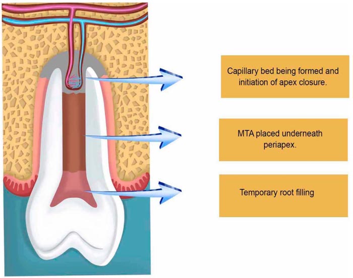 Mechanisms Involved in Apice Closure of Pulpless Teeth – Literature Review