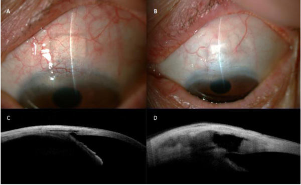 The Open Ophthalmology Journal :: Volume 13 - 2019