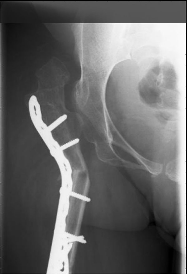 Pelvic Support Osteotomy; Salvage Procedure in Chronically Dislocated ...
