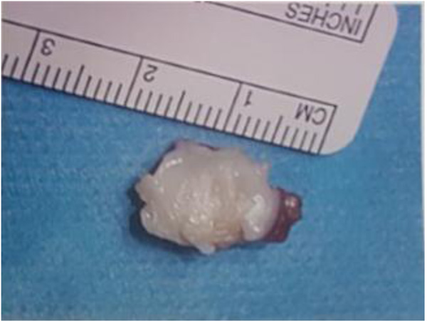 Fabella Syndrome Following De-Rotation Surgery to Correct a Femoral ...
