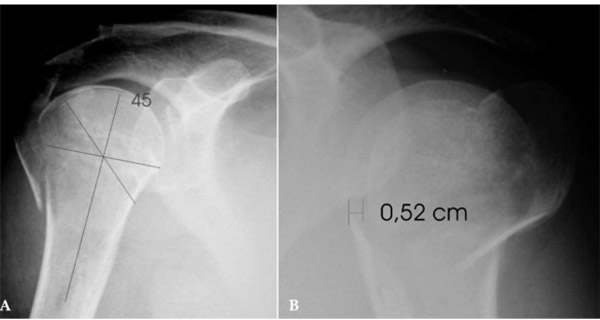 Transosseous Suture Fixation of True 4-part Valgus Impacted Fractures ...