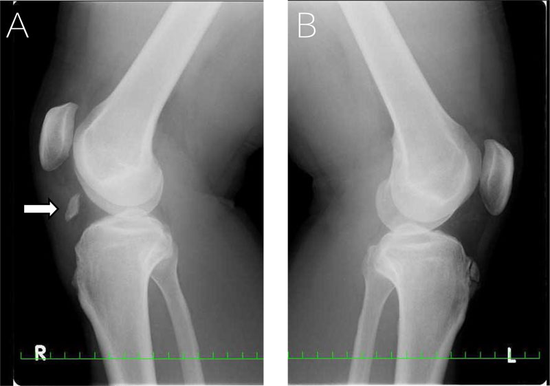 Bifocal Disruption of the Patellar Tendon with Avulsion of the Tibial ...