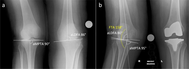 Kinematic Alignment Technique for TKA on Degenerative Knees with Severe ...