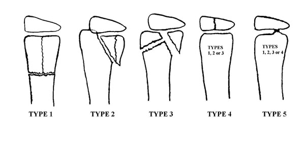 Classification Of Distal Radius Physeal Fractures Not Included In The